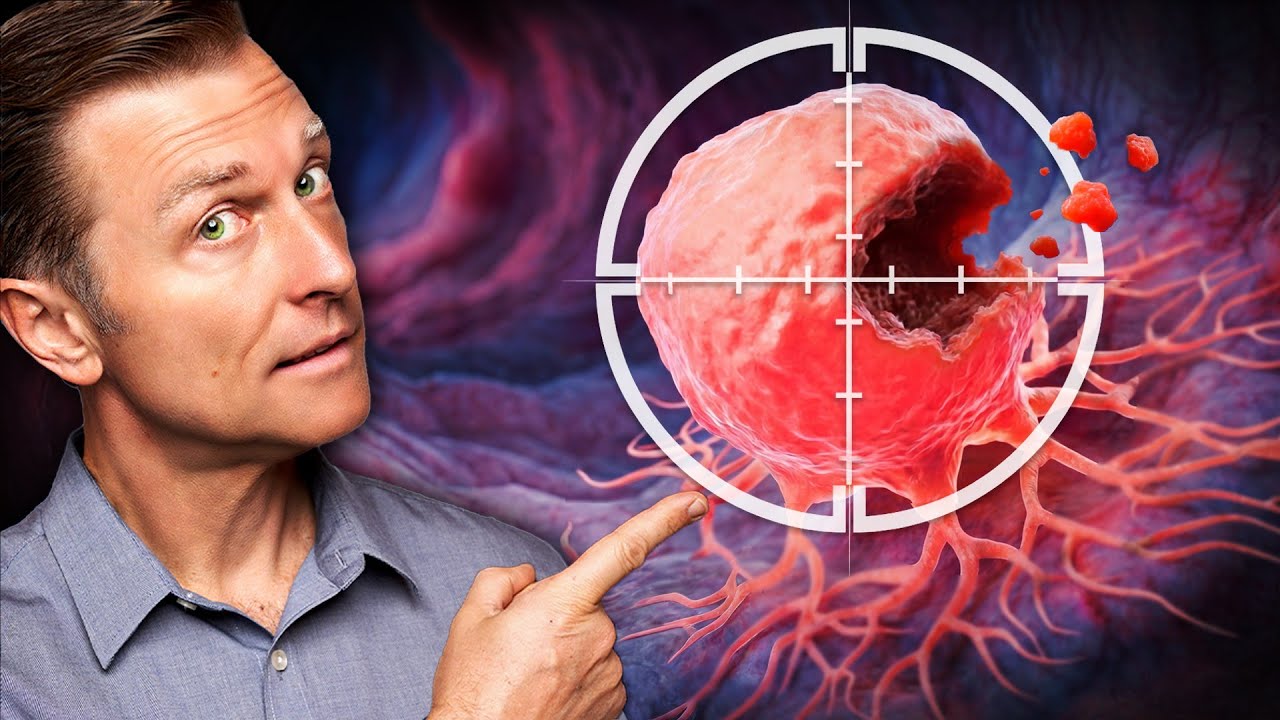 Death of Advanced-Stage Colon Cancer - New World Disorder